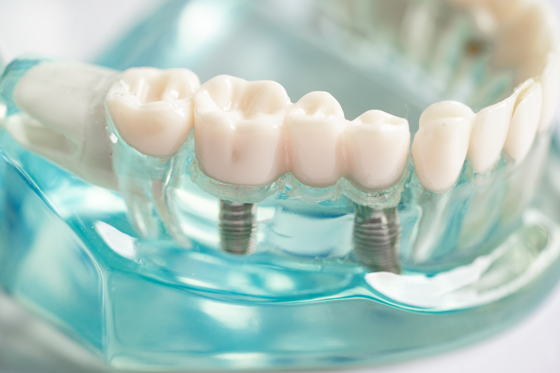 All on 4 Dental Implants Marylebone - Full Dental Implants Mayfair